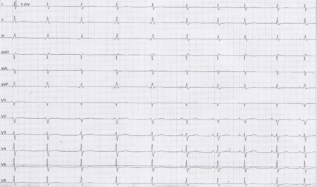 Wandering pacemaker — Uness Cardiologie