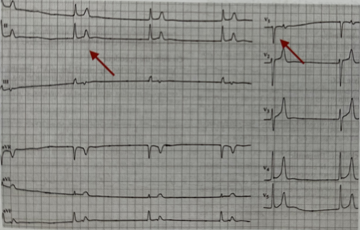 Onde P rétrograde — Uness Cardiologie