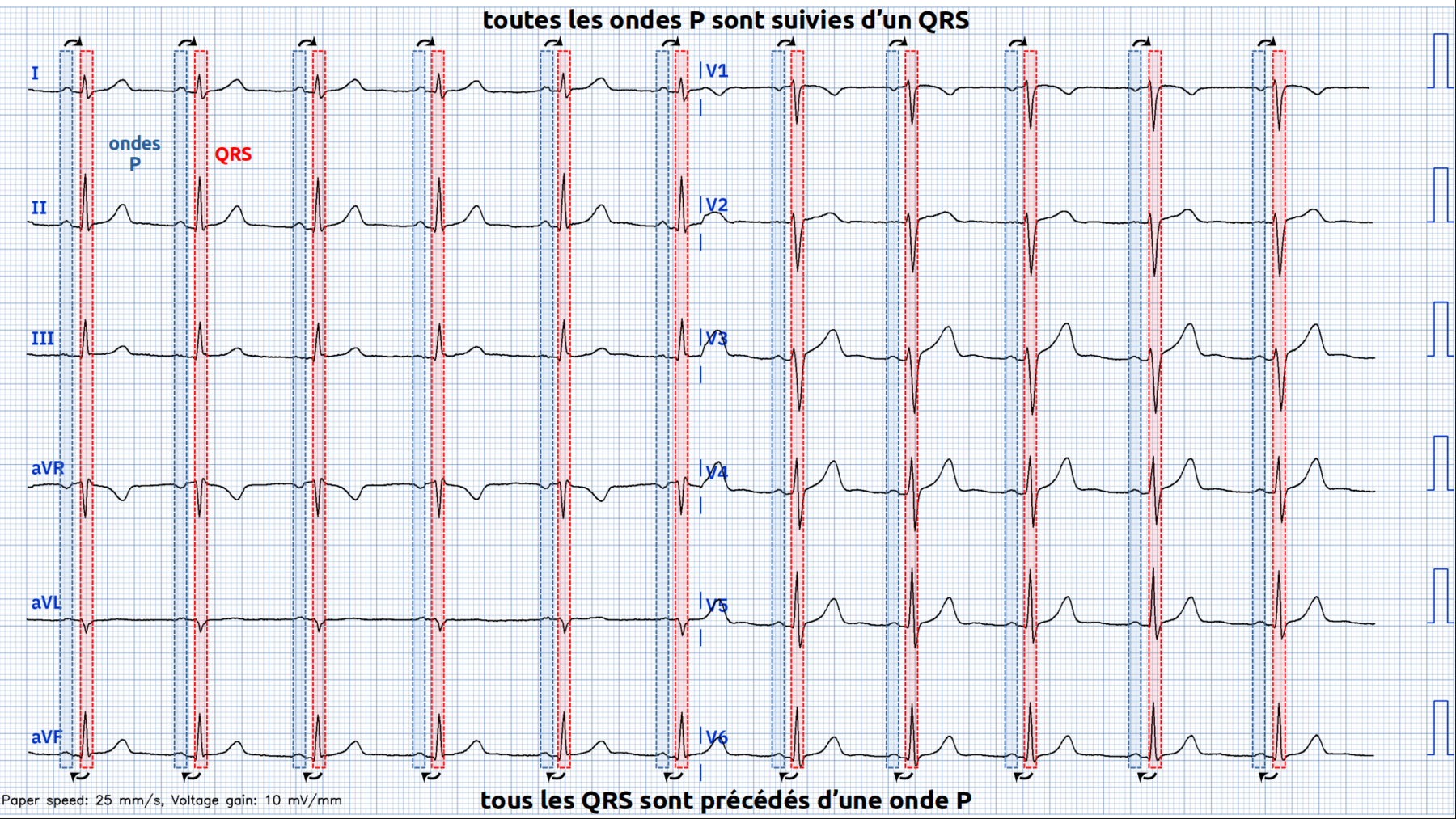 Electrocardiogramme normal — Uness Cardiologie