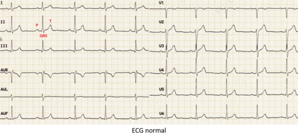 Rythme sinusal — Uness Cardiologie