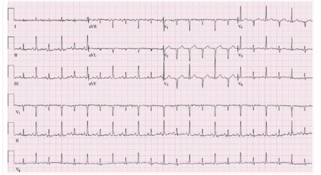 Alternance électrique des QRS ou de l'onde T — Uness Cardiologie