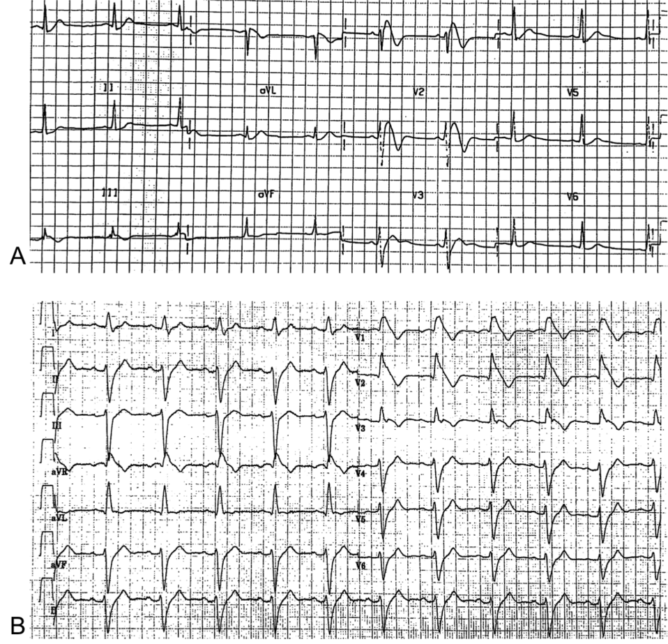 Syndrome de Brugada — Uness Cardiologie