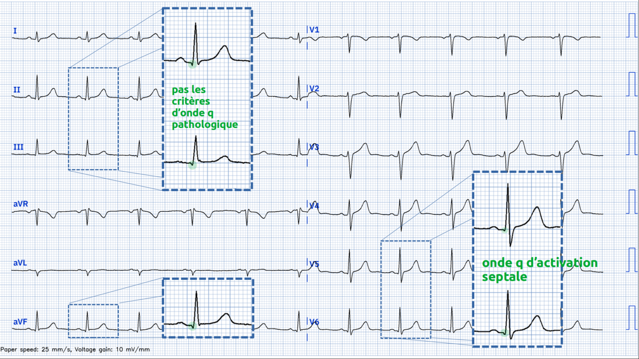 Electrocardiogramme normal — Uness Cardiologie