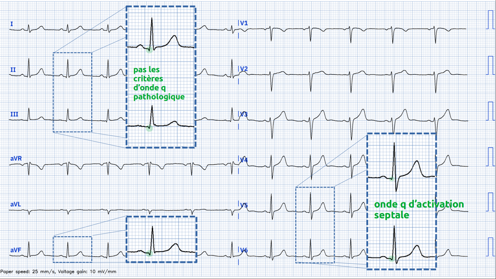 Electrocardiogramme normal — Uness Cardiologie
