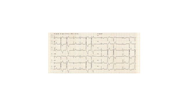 Extrasystole ventriculaire (ESV) — Uness Cardiologie