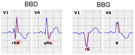 Bloc de branche: généralités — Uness Cardiologie