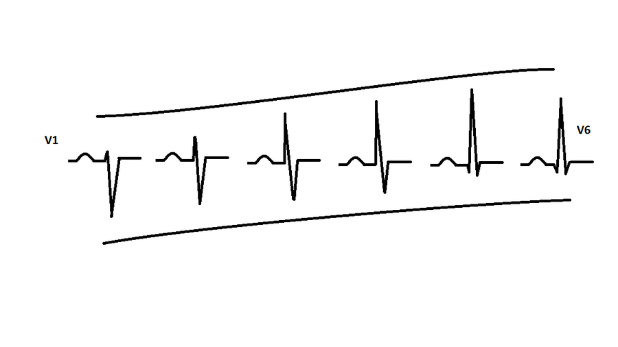 Onde R — Uness Cardiologie