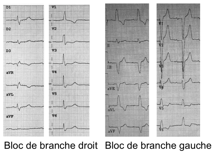 Anomalie de la repolarisation: généralités — Uness Cardiologie