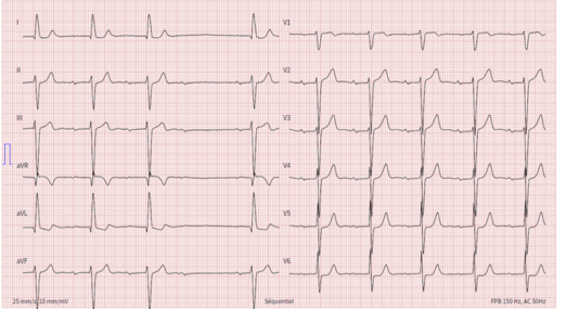 Bloc AV 2e degré: Généralités — Uness Cardiologie