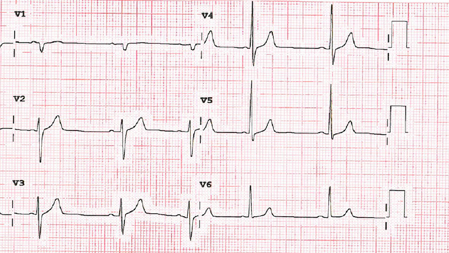 Onde R — Uness Cardiologie